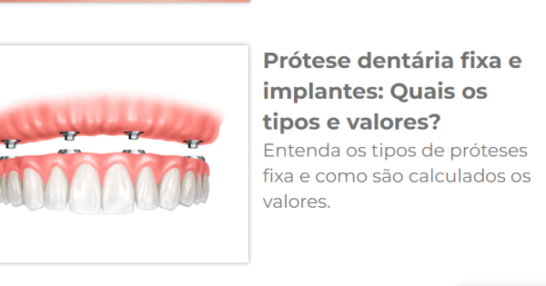 Barreirodonto | Prótese dentária fixa e implantes, quais os tipos e valores